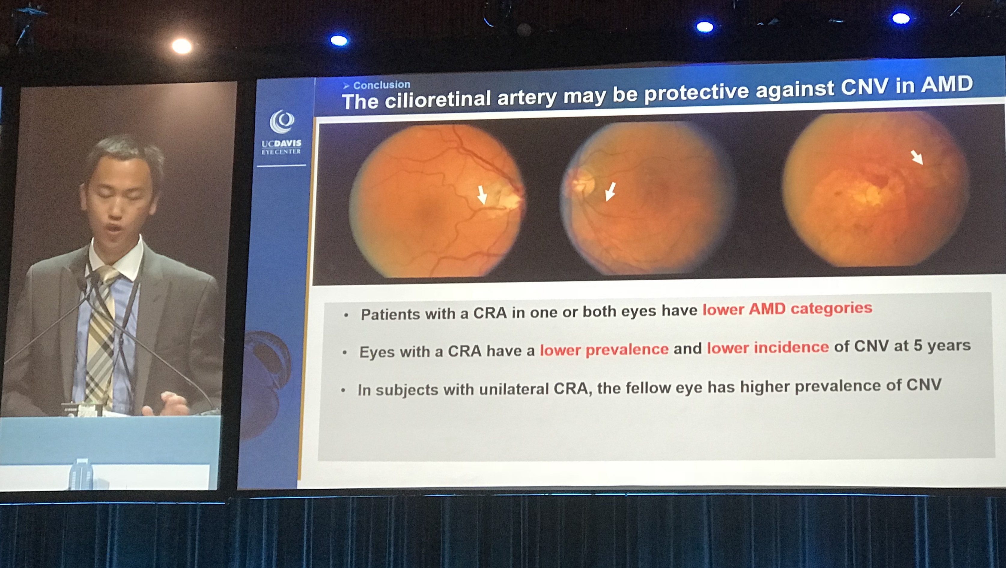 ASRS 2018: Neovascular AMD – RETINA Roundup