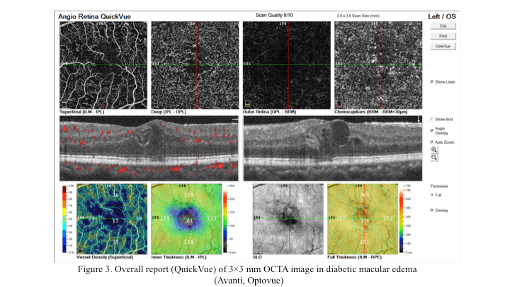 Which OCTA Machine Should You Get? Pros and Cons of Each System ...