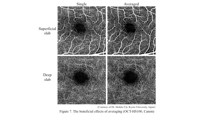 Which OCTA Machine Should You Get? Pros and Cons of Each System ...